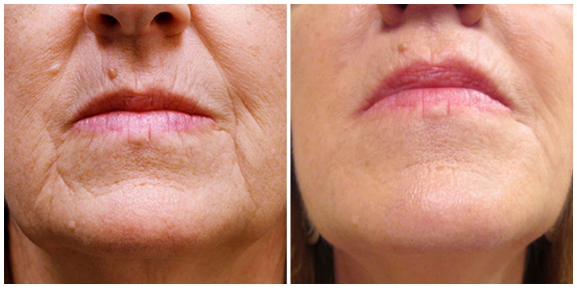 Aplicación de Relleno